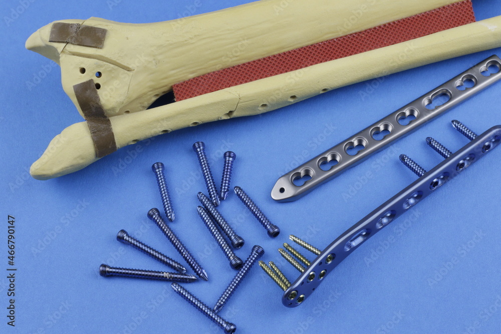 Surgical plates and instruments for osteosynthesis of bone fractures ...