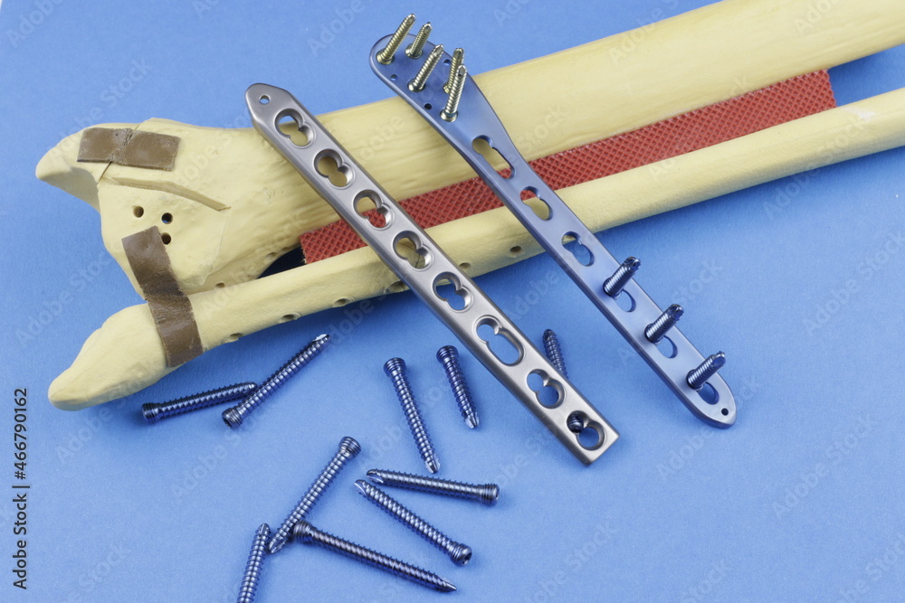 Surgical plates and instruments for osteosynthesis of bone fractures ...