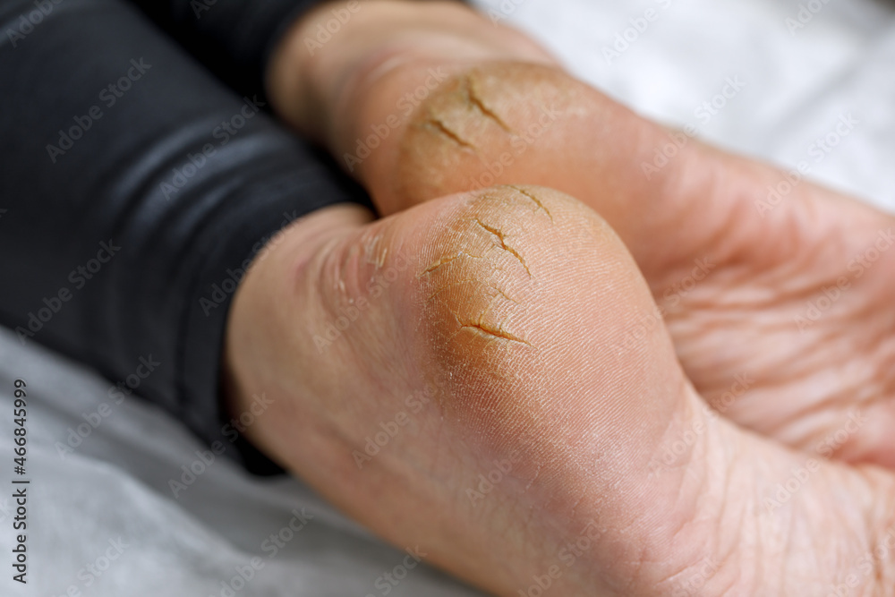 Cracked heels in a woman. Medical pedicure in the salon. Problematic ...