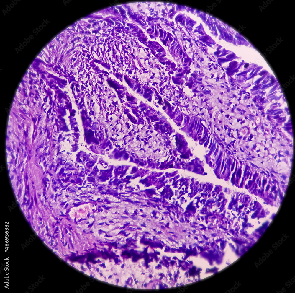 Colon Cancer: Photomicrograph (microscopic image) of colorectum ...