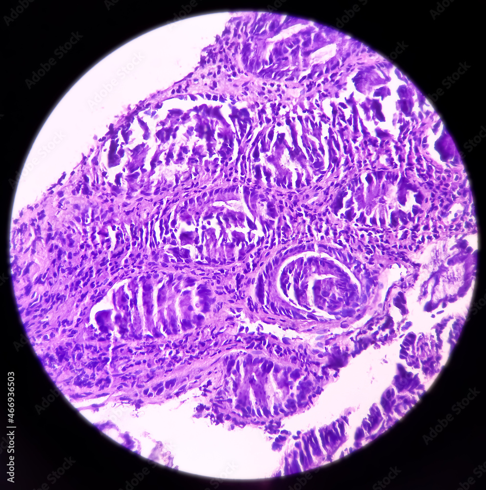 Colon Cancer: Photomicrograph (microscopic image) of colorectum ...