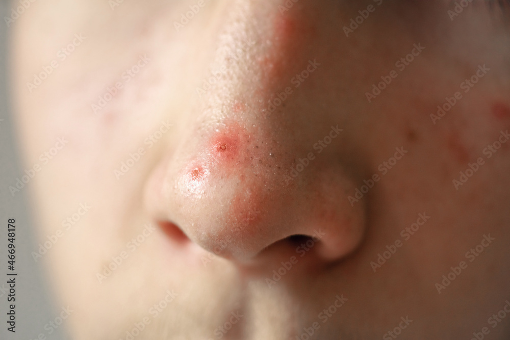 large pimple on the nose close-up, black pores, oily skin, teenage ...