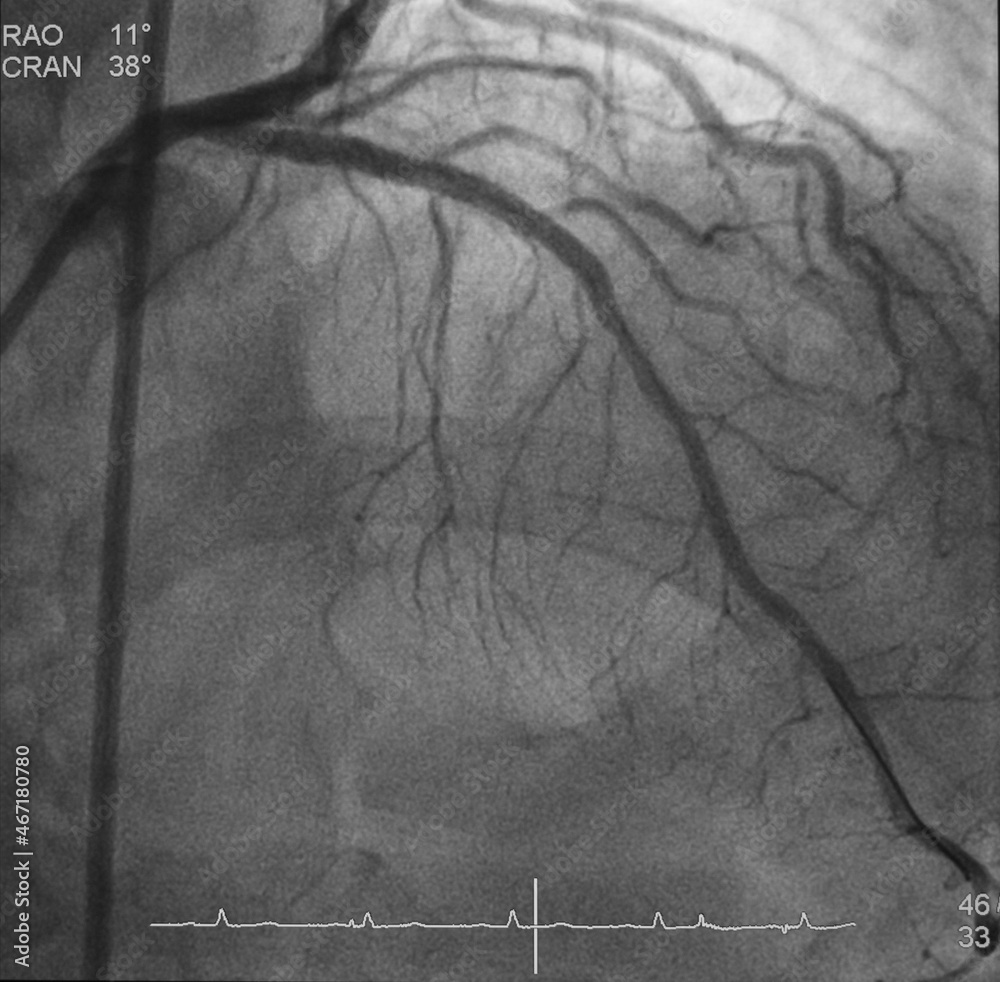 Coronary angiogram (CAG) was performed successful percutaneous coronary ...