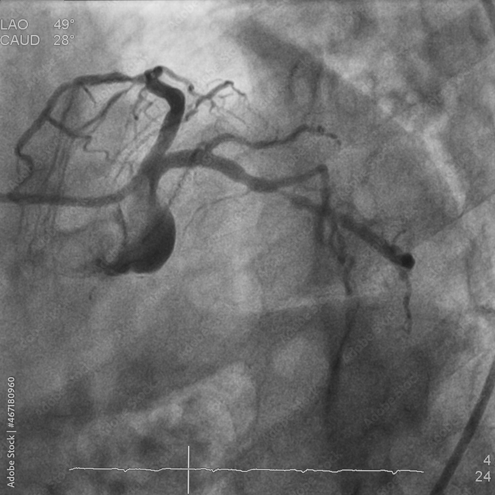 Coronary angiogram (CAG) was performed left anterior descending artery ...