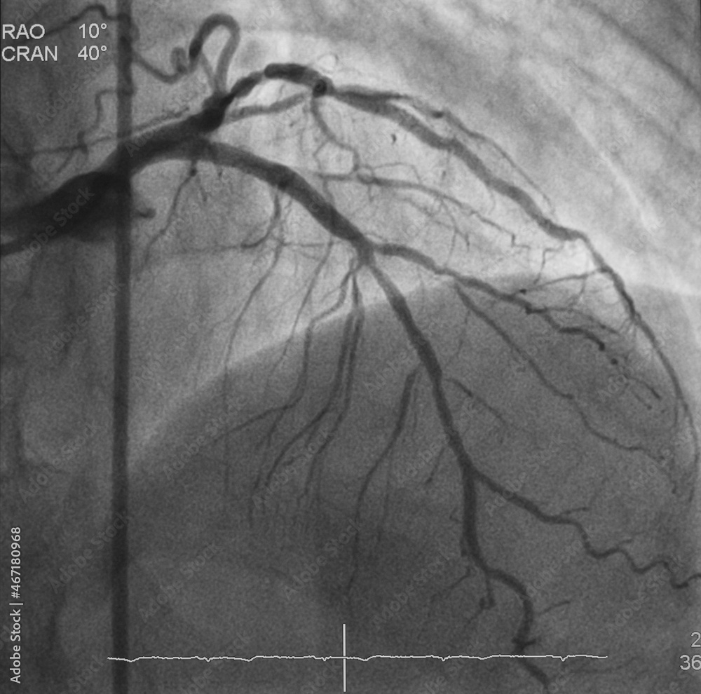 Foto de Coronary angiogram (CAG) was performed left anterior descending ...