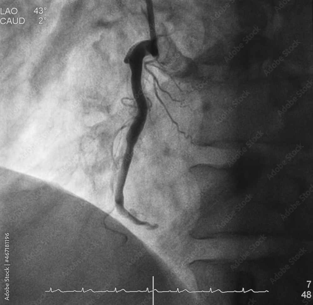 Coronary angiogram (CAG) was performed total occlusion at right ...