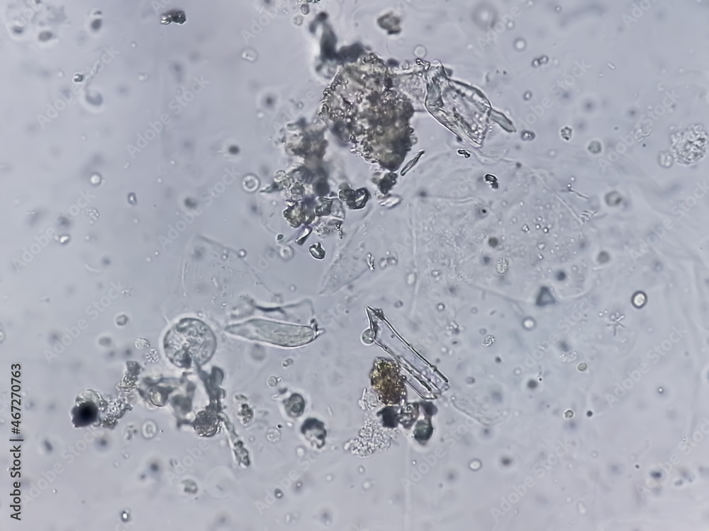 Microscopic view of abnormal urine analysis showing granules casts and ...