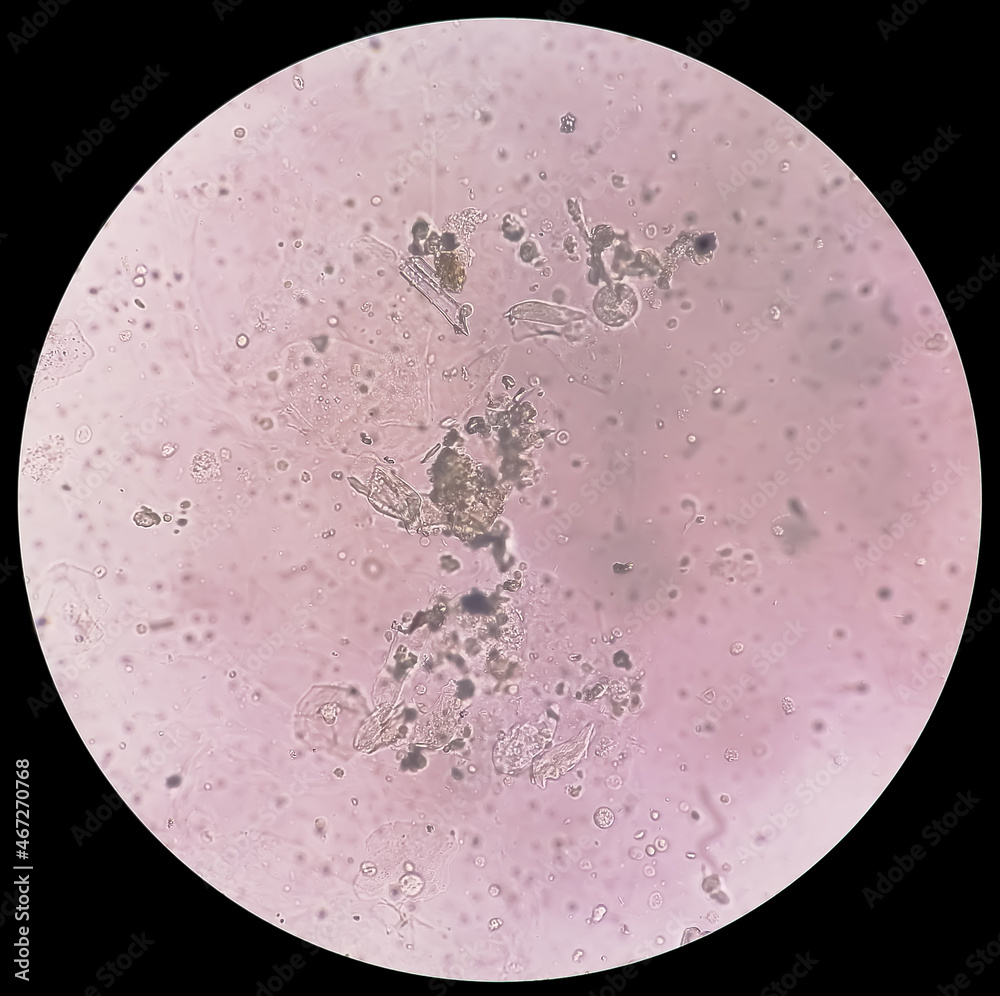 Microscopic view of abnormal urine analysis showing granules casts and ...