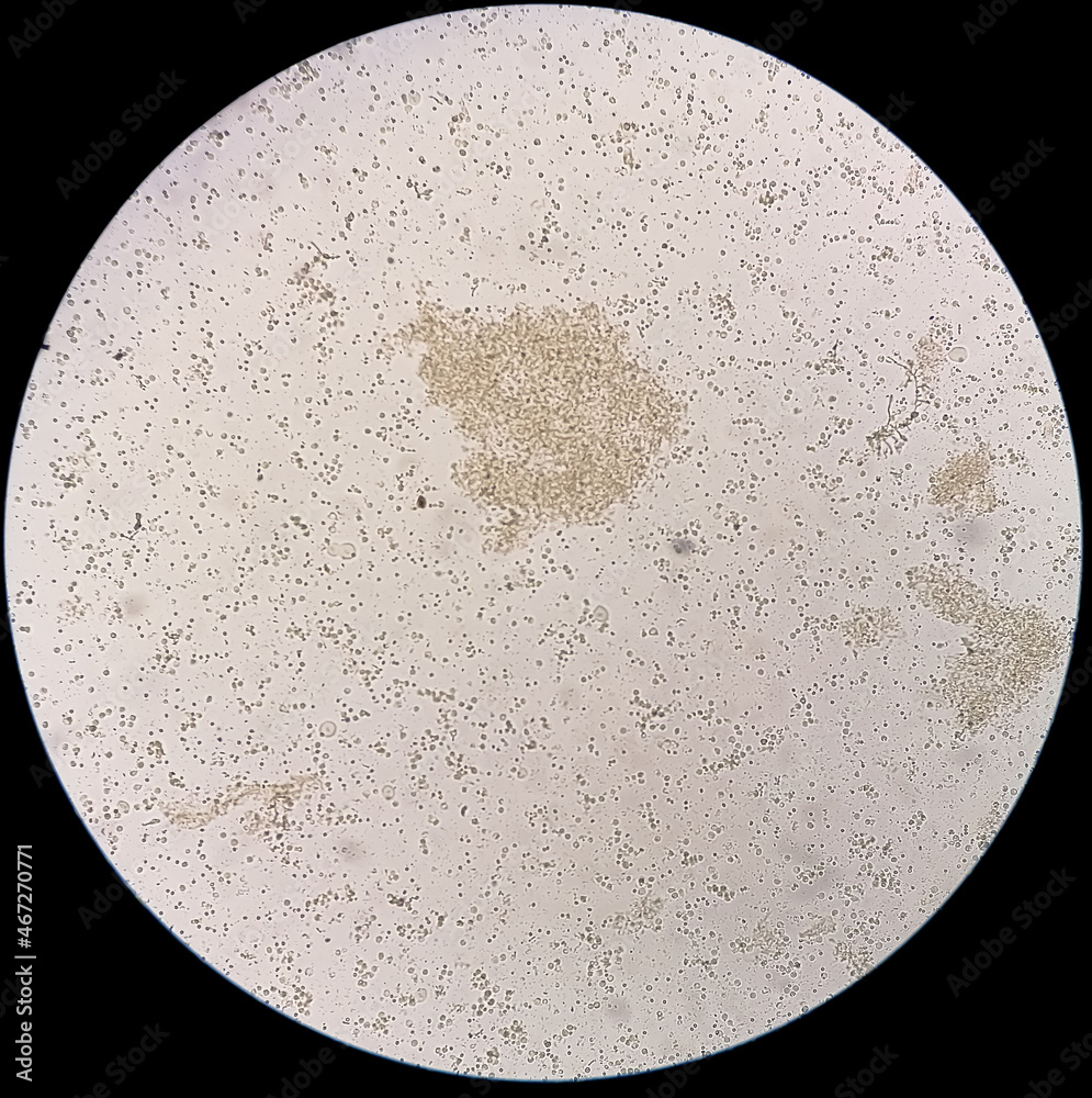 Photomicrograph of urine analysis showing yeast, RBC and pus cell ...