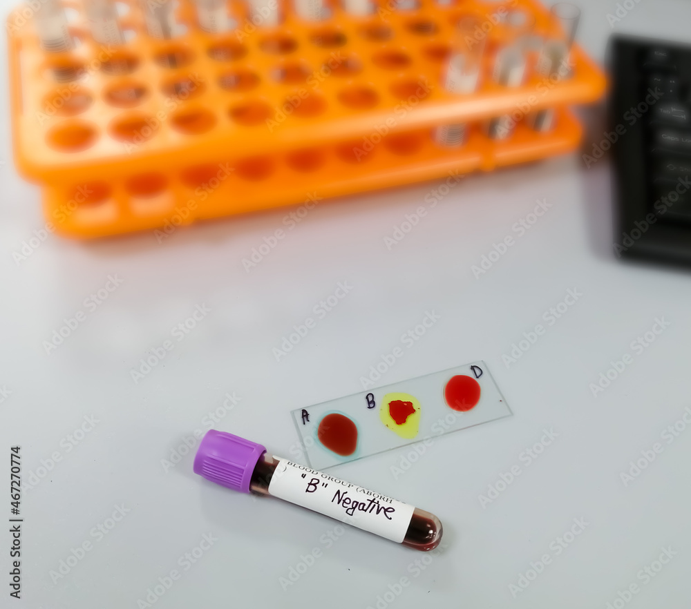 Blood group and Rh factor testing by slide agglutination method with ...