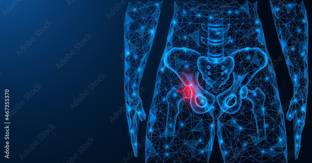 Inflammation and pain in the human hip joint. The skeletal part in the ...