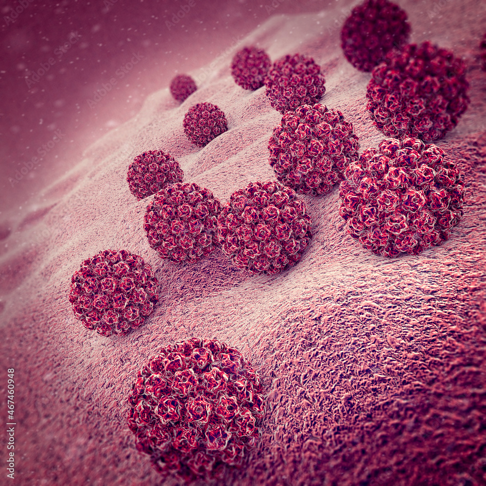 Human Papillomavirus Infection Virus Hpv Is The Most Common Sexually