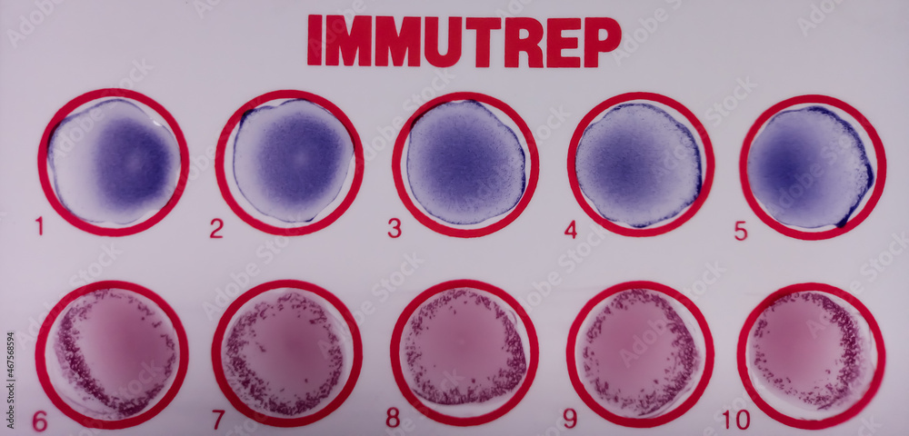 Widal Test By Agglutination Method At Plate Isolated On White Background To Diagnosis Typhoid