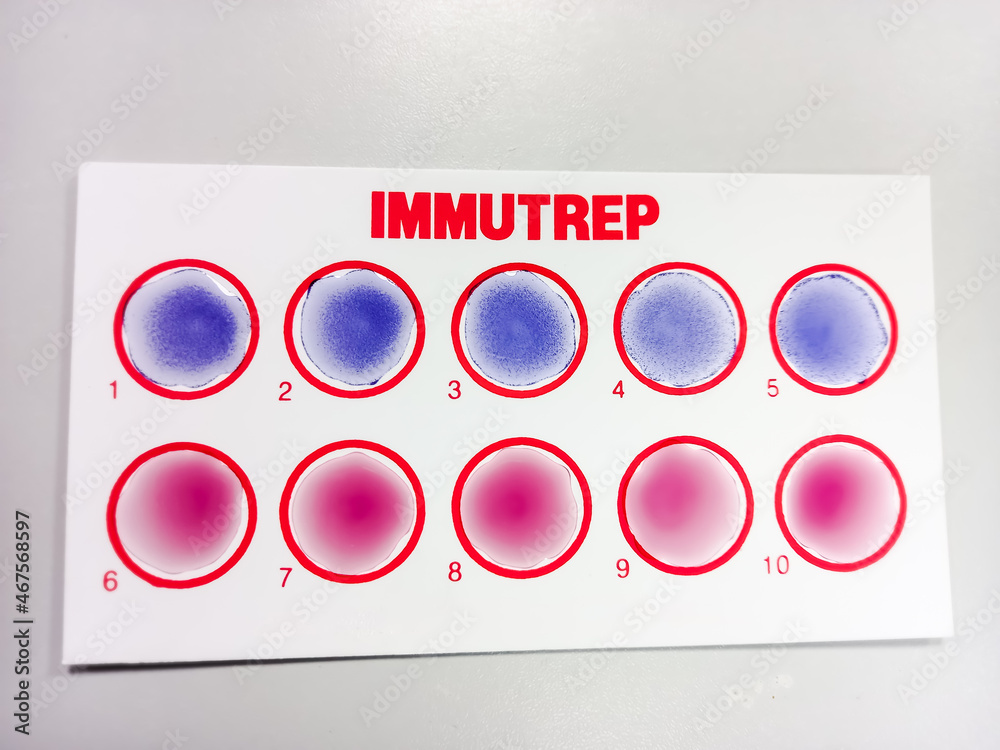 Widal test by agglutination method at plate isolated on white ...