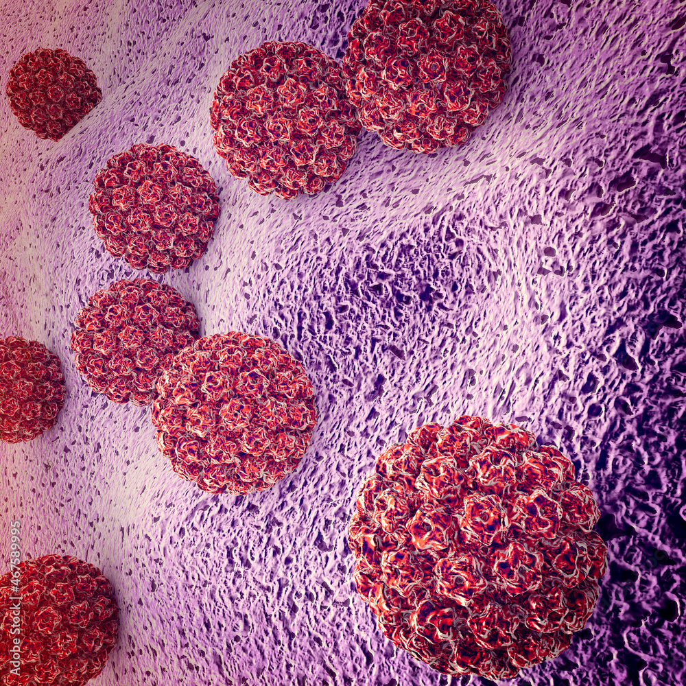 Human papillomavirus infection. Virus. HPV is the most common sexually ...