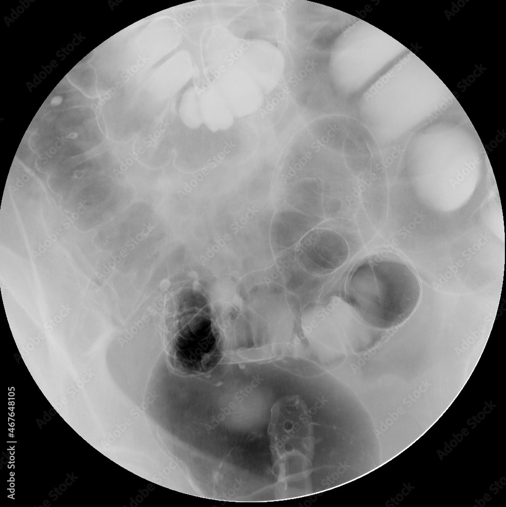 Barium enema image or x-ray image of large intestine. Colorectal x-ray ...