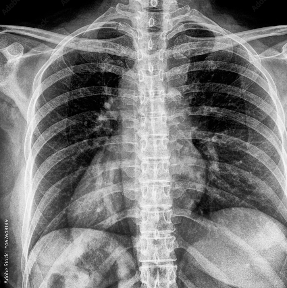 X-ray scan of human spine. Medical examination result Stock Photo ...