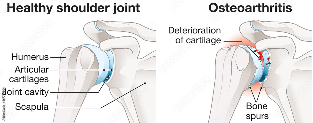 Osteoarthritis of the shoulder joint Stock Illustration | Adobe Stock