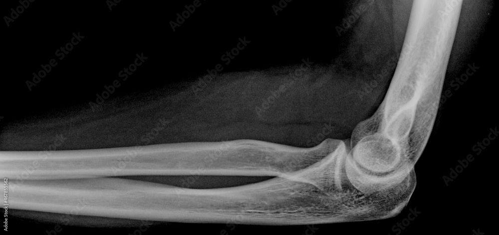 x ray image of human elbow joint Stock Photo | Adobe Stock