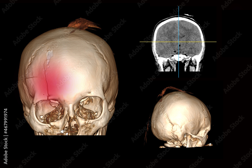 3d computed tomography of the brain with a fracture of the frontal part ...