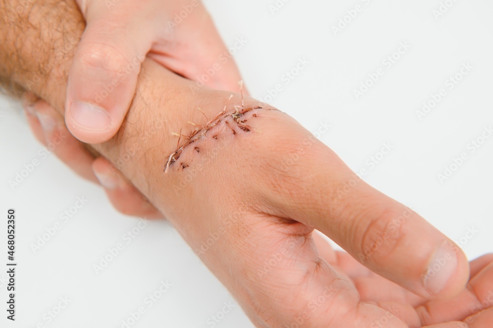 Suture wound on hand from dermatology procedure Stock Photo | Adobe Stock
