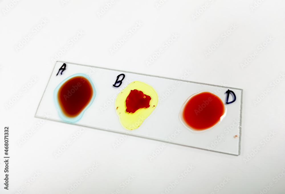 Blood group and Rh factor testing by slide agglutination method. Blood ...