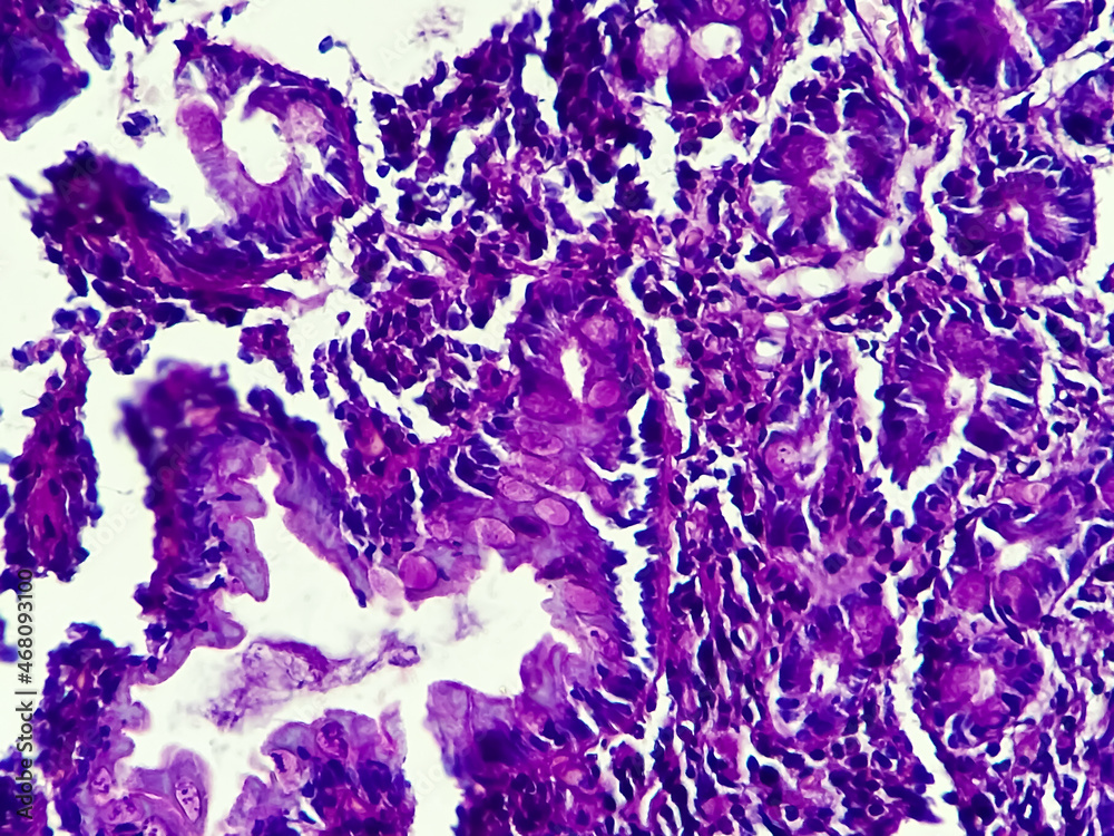 Squamous cell carcinoma of a human, photomicrograph panorama as seen ...
