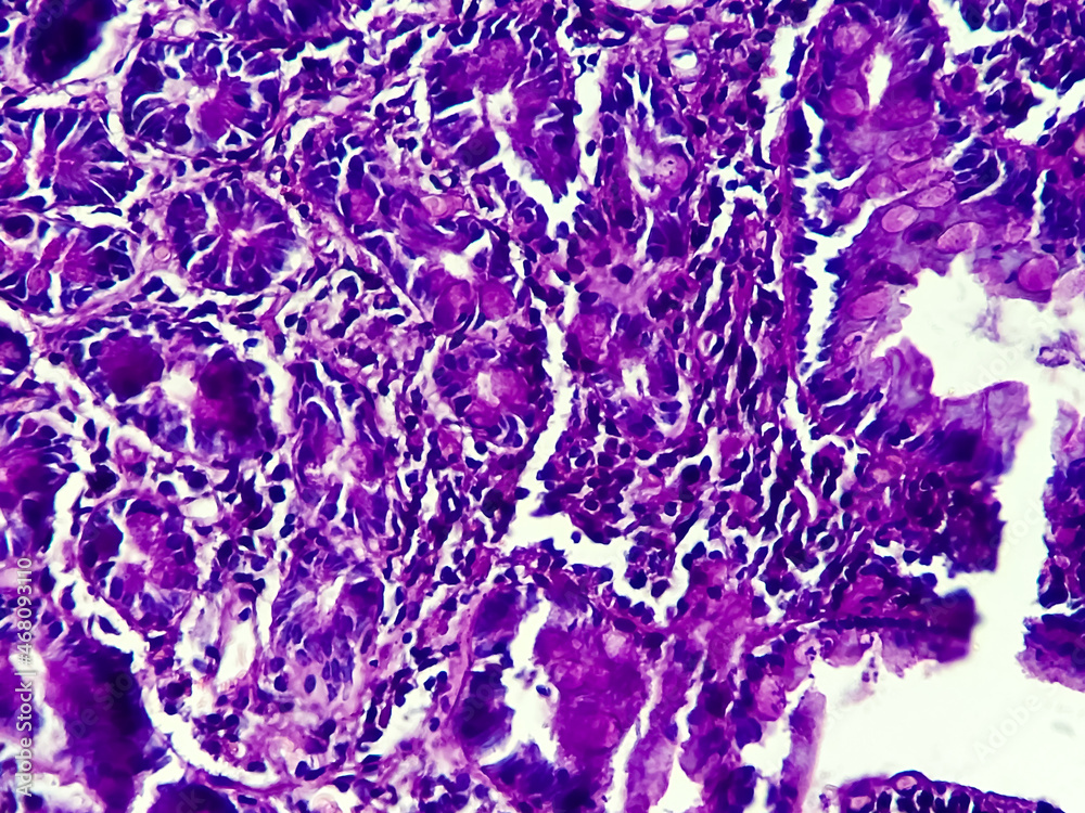Squamous cell carcinoma of a human, photomicrograph panorama as seen ...