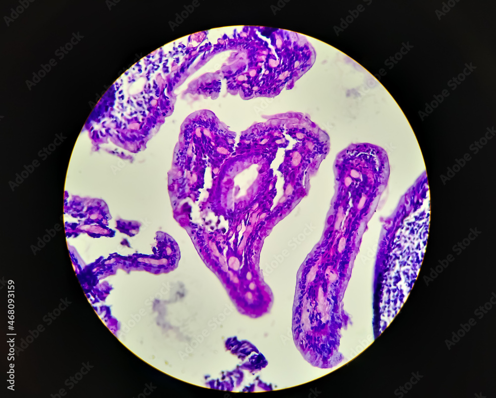 Squamous cell carcinoma of a human, photomicrograph panorama as seen ...