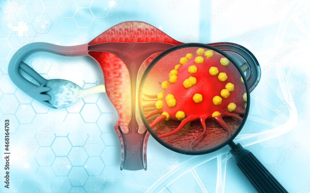 Female reproductive system diseases. Uterus cancer and endometrial ...