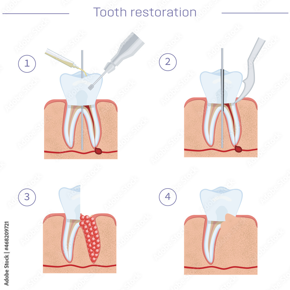 Tooth treatment, step by step instructions. Hemisection, root removal ...