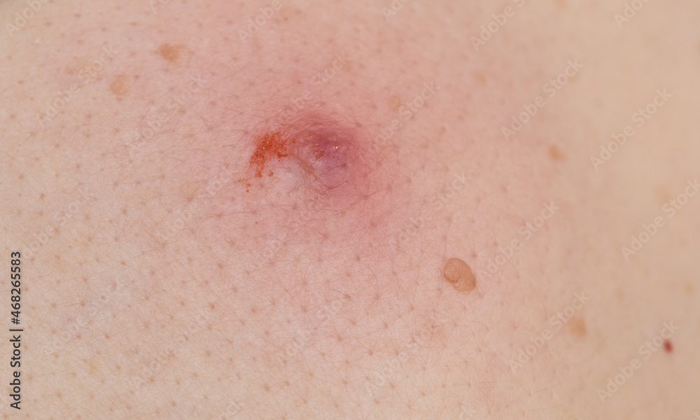 skin after extraction of a large tick. Ixodes ricinus. Dangerous insect ...