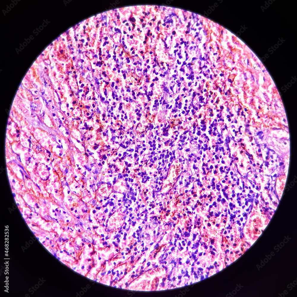 Microscopic image of chronic epididymo-orchitis in testis tissues ...