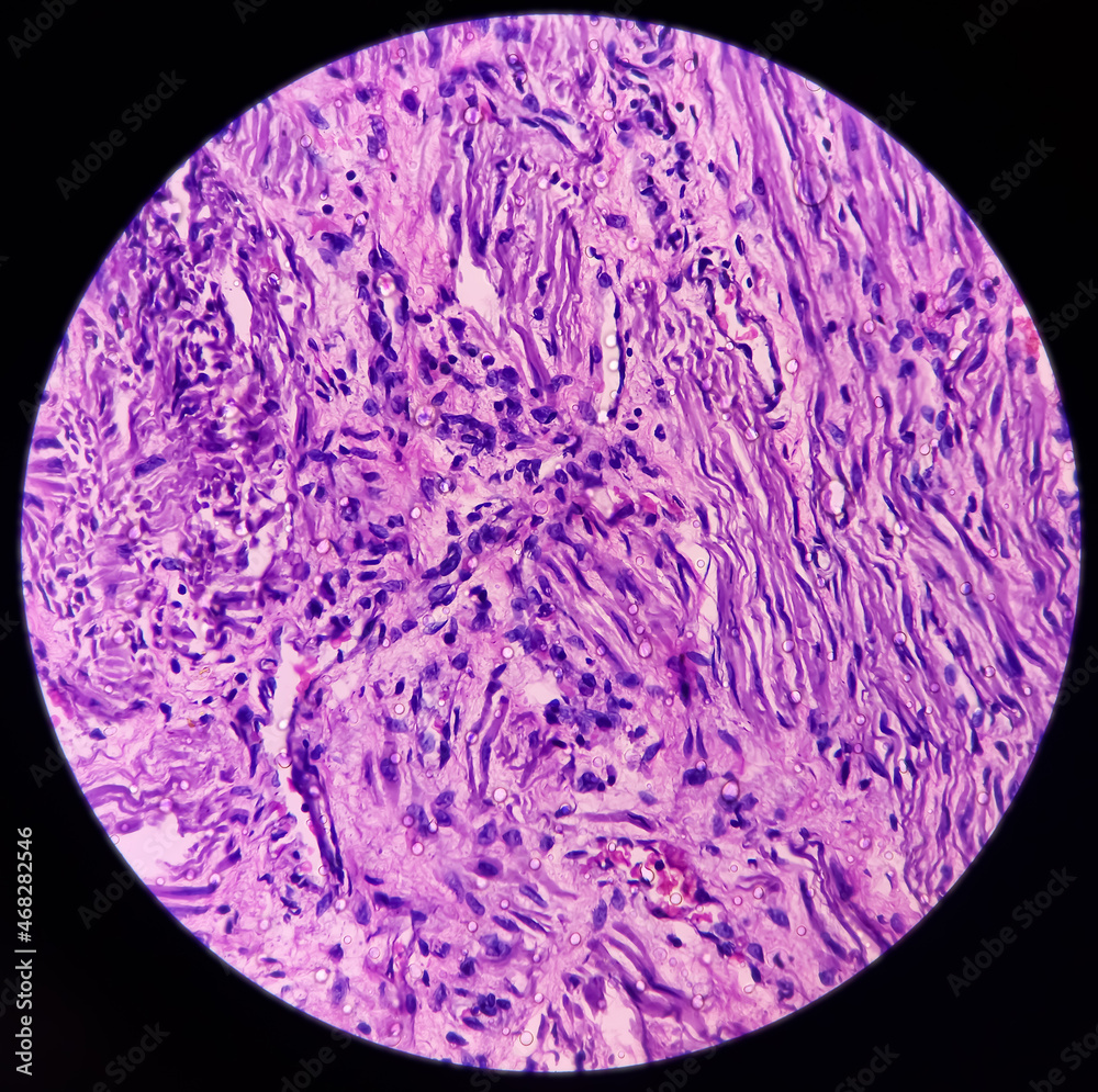 Microscopic image of chronic epididymo-orchitis in testis tissues ...