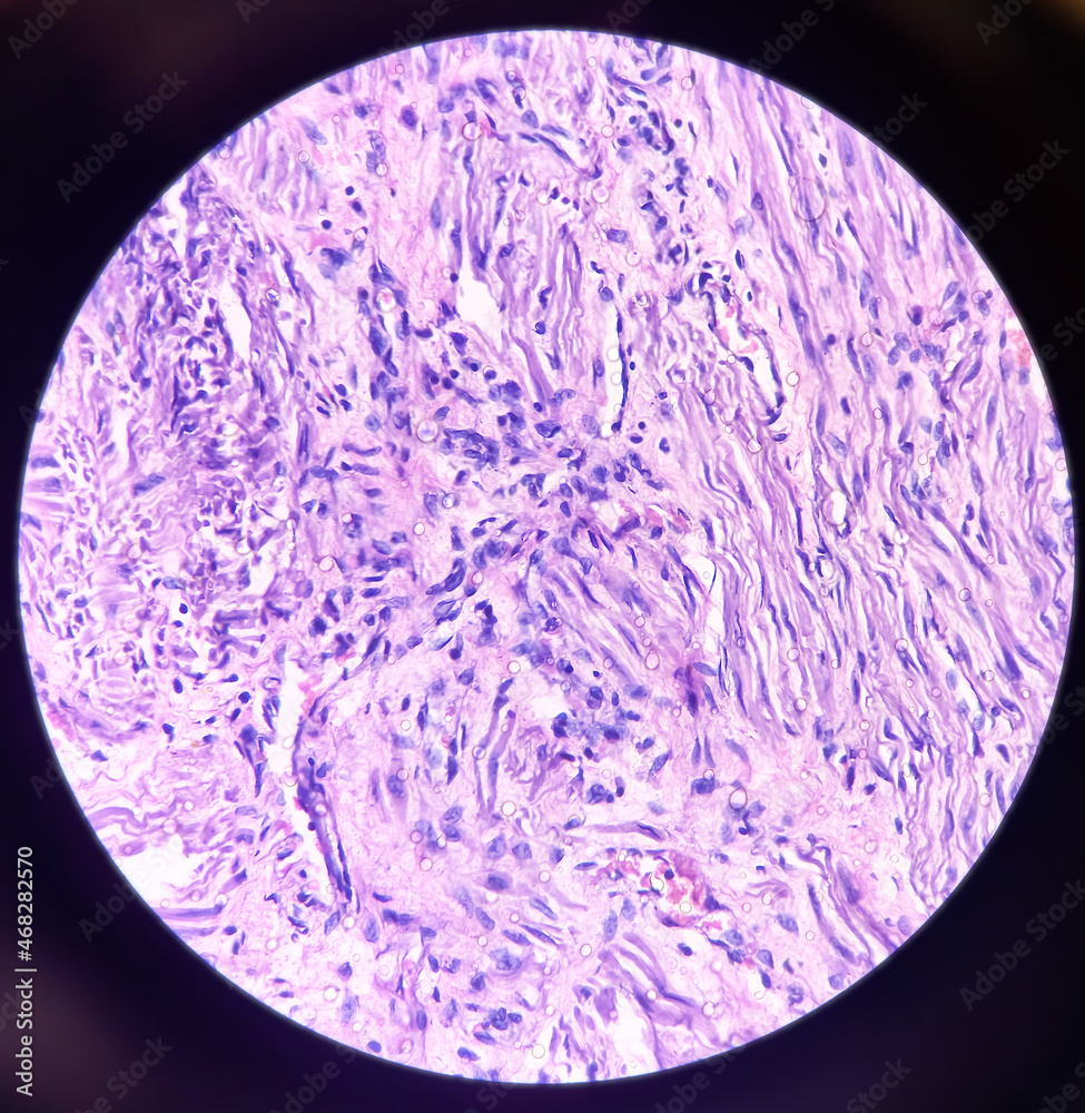 Microscopic image of chronic epididymo-orchitis in testis tissues ...