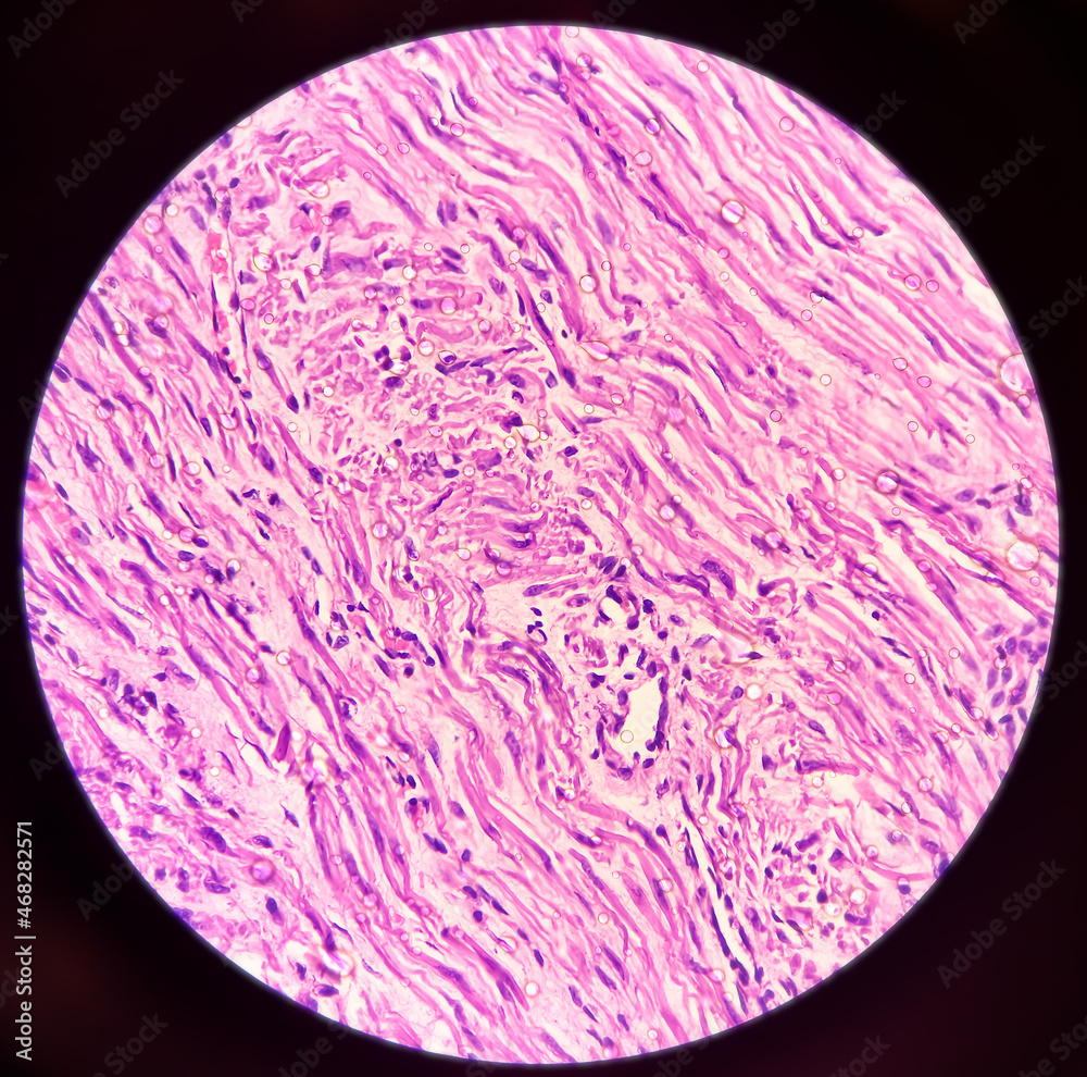 Microscopic image of chronic epididymo-orchitis in testis tissues ...
