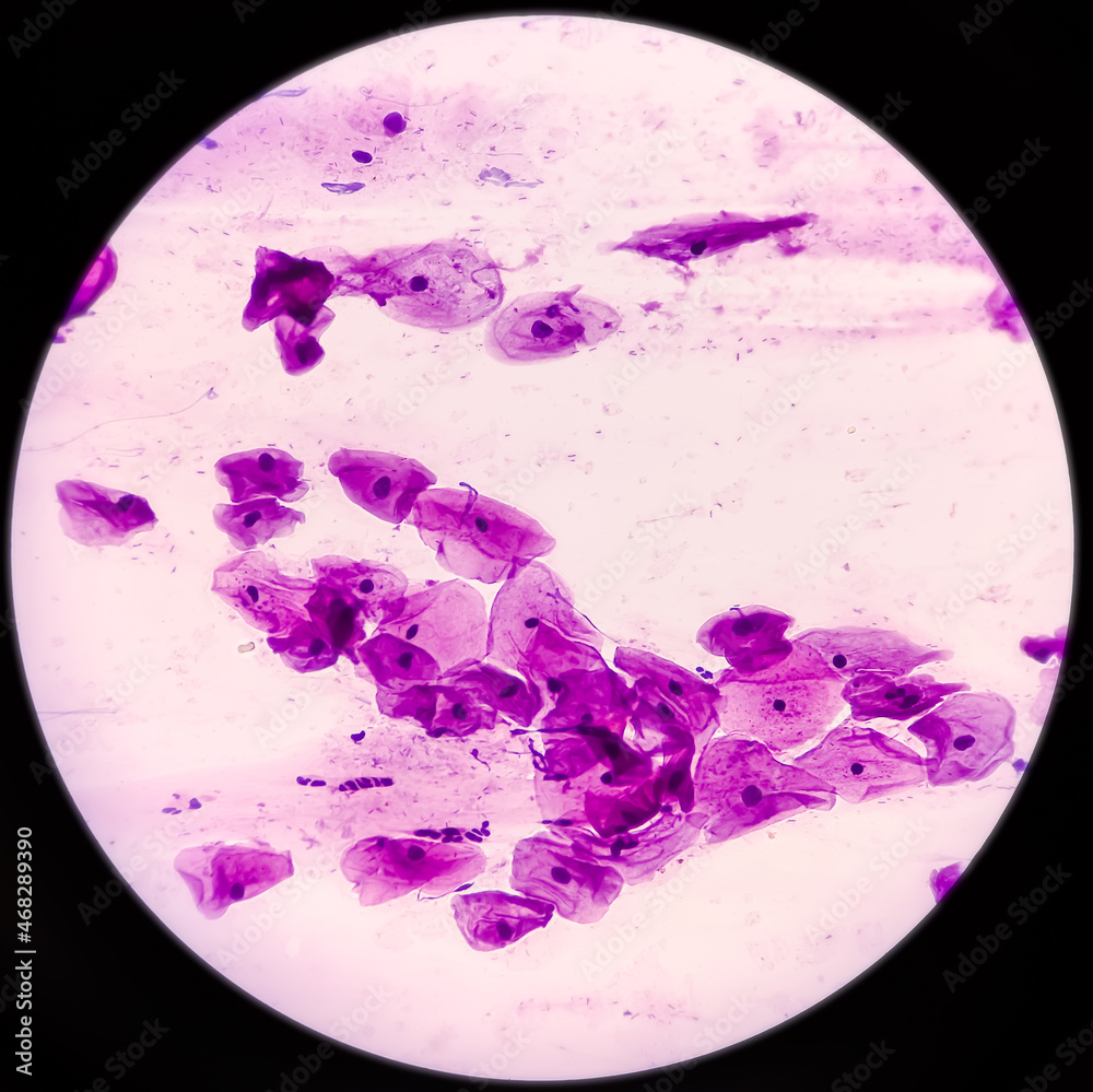Póster Cervical smear (paps) cytology at histopathology laboratory ...