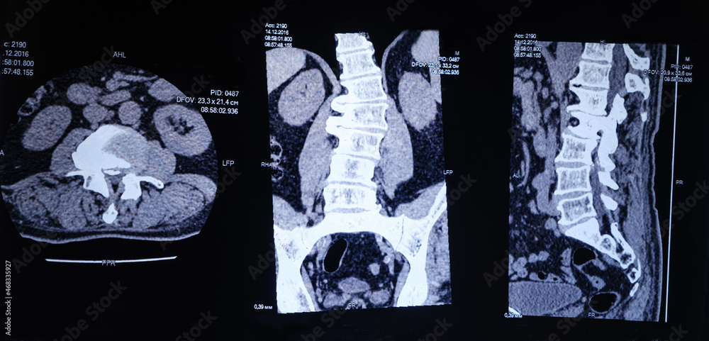 CT image of the spine of a patient with scoliosis and protrusion of the ...