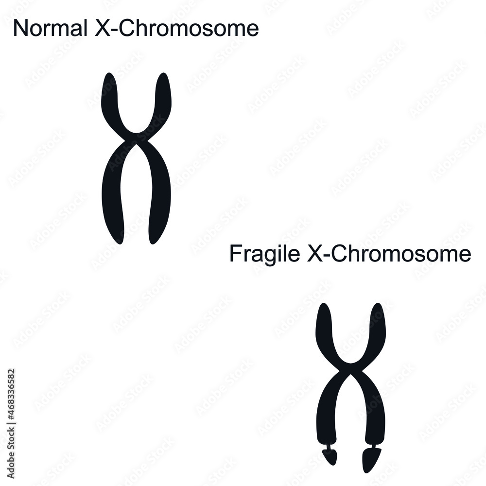Fragile x syndrome genetics logo icon sign Vector illustrated article ...