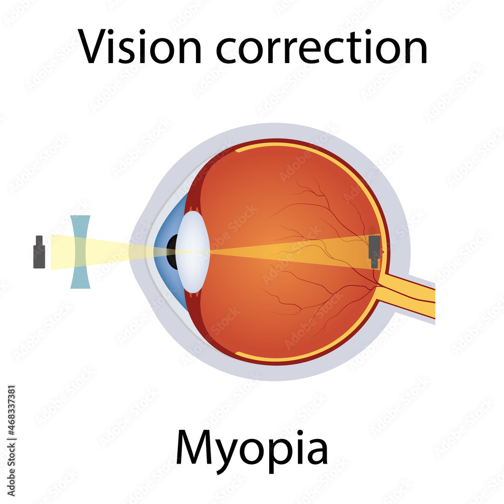 Vision Correction of Myopia Illustration. Eyesight Disorders. Eyes ...