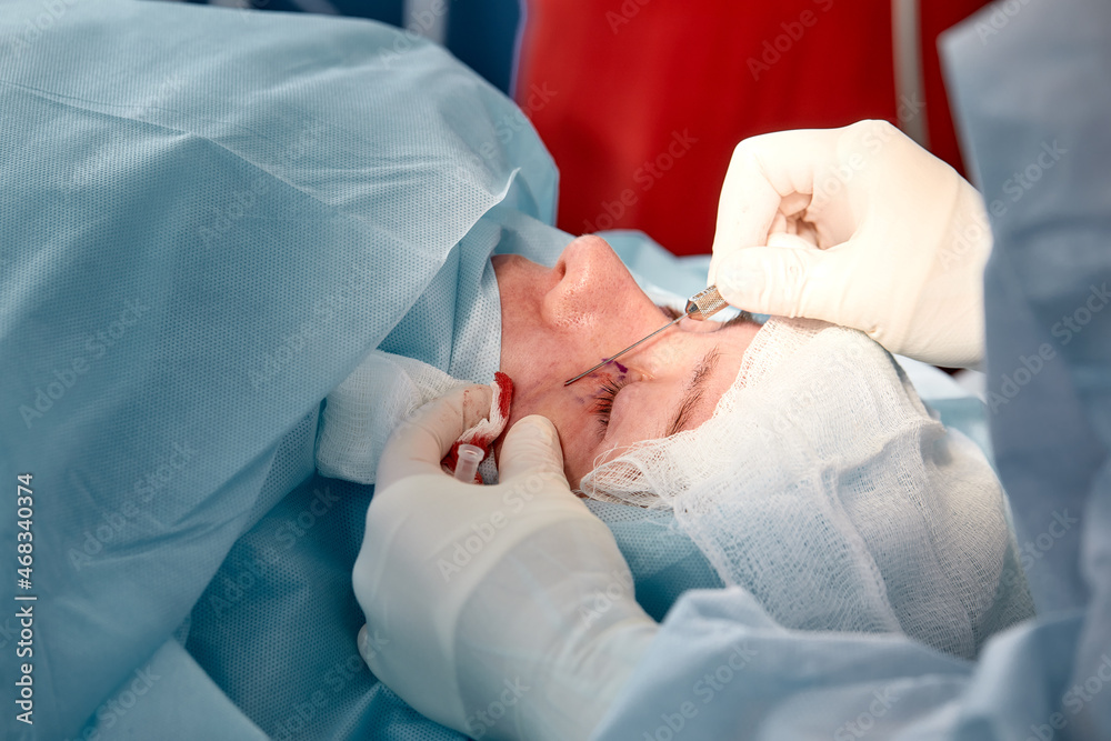 Close up of the face of a patient who is undergoing blepharoplasty. The ...