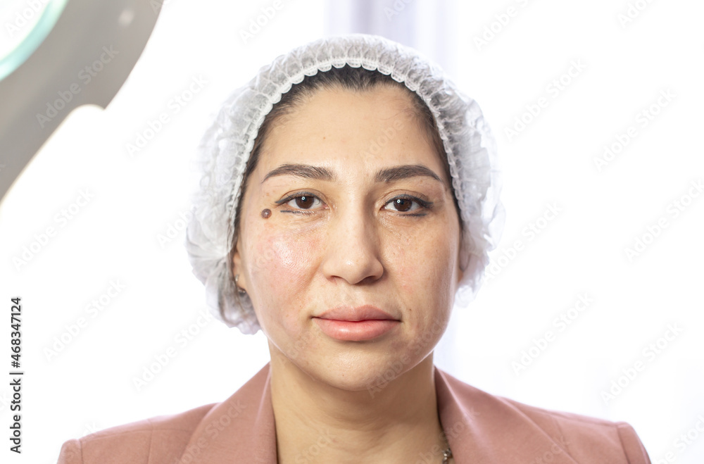 Thread lifting is a cosmetological procedure for face rejuvenation ...
