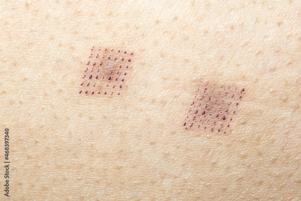 Marks after laser hair or scar removal from the skin. CO2 technique ...