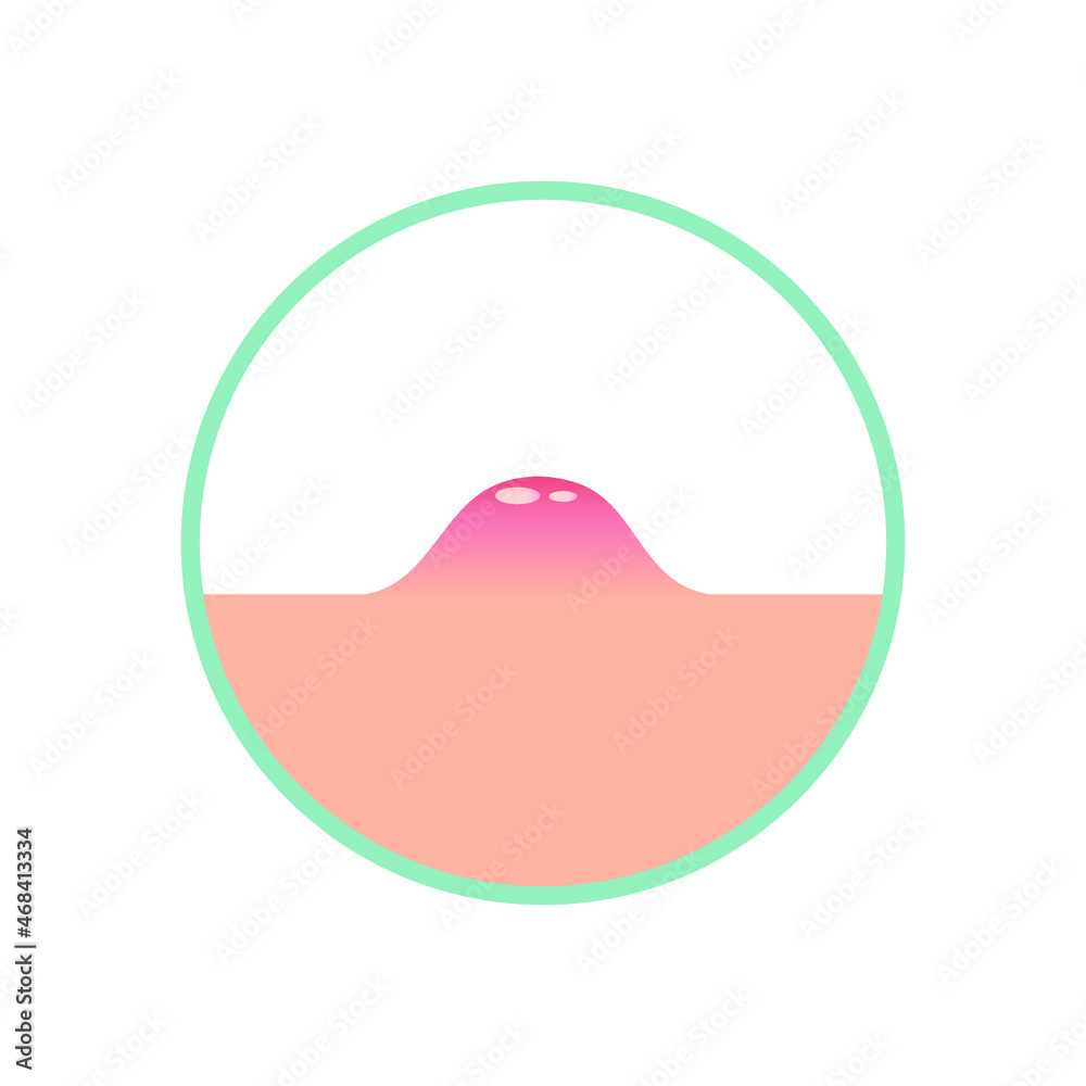 A pimple rises above the skin, circle illustration. Purulent ...