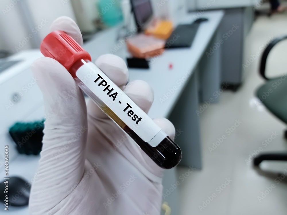 Biochemist or doctor holds blood sample for Treponema pallidum ...