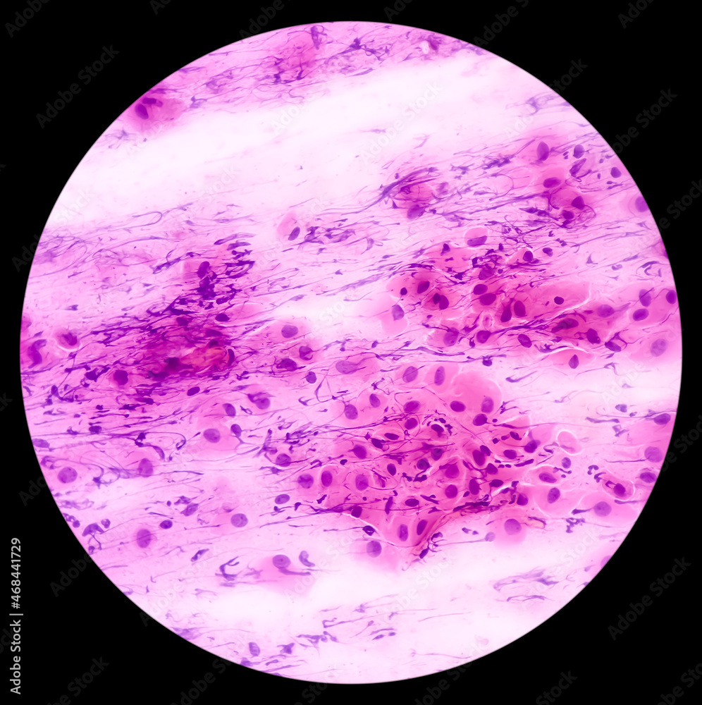 Vault smear: Reactive cellular changes with inflammation, photo under ...