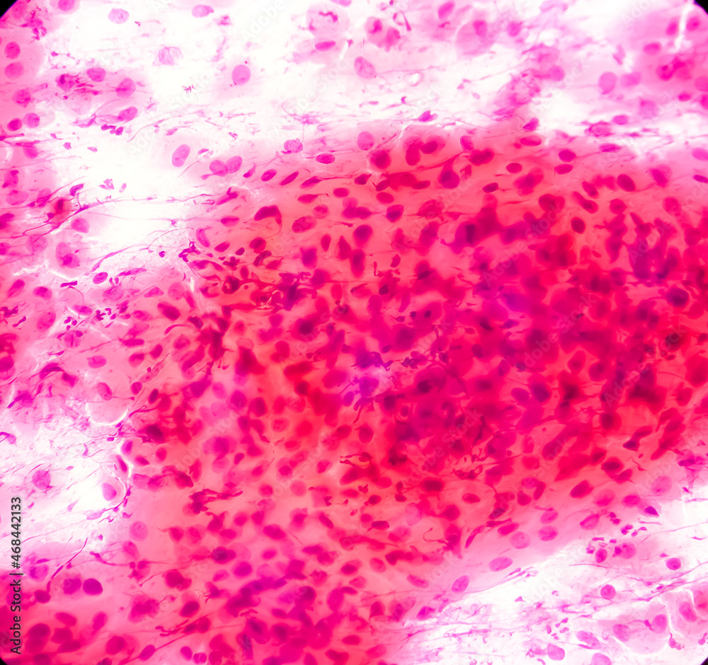 Vault smear: Reactive cellular changes with inflammation, photo under ...