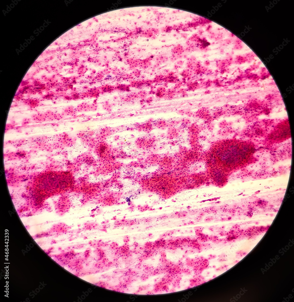 Vault smear: Reactive cellular changes with inflammation, photo under ...
