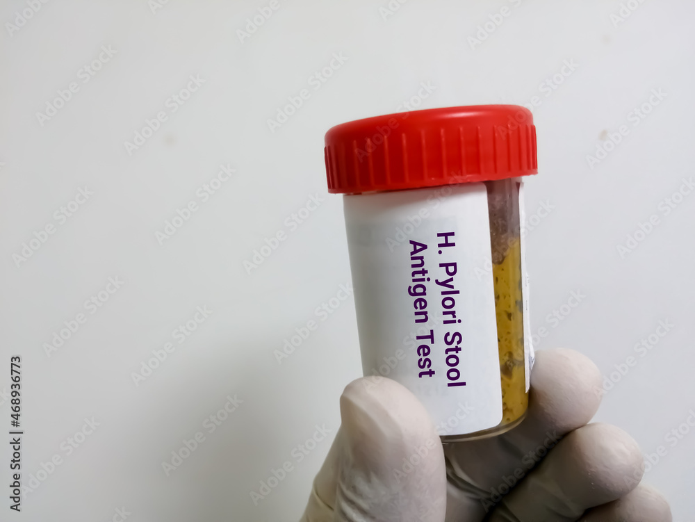 Scientist hold container with stool sample for H. pylori stool antigen ...
