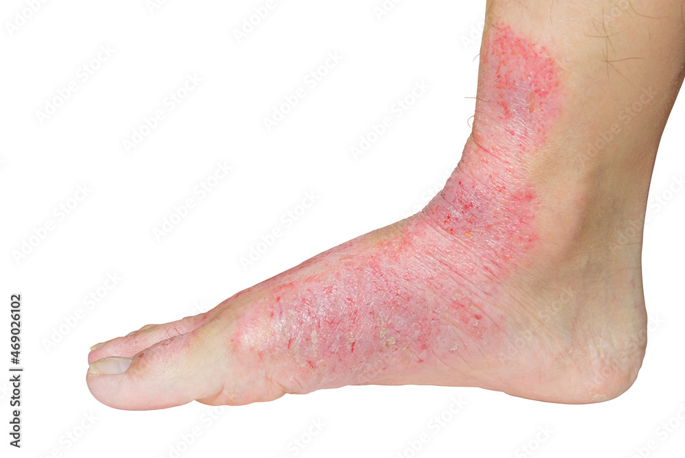 Isolated foot. Rash, Wound, and Dry skin on human foot. Stock Photo ...
